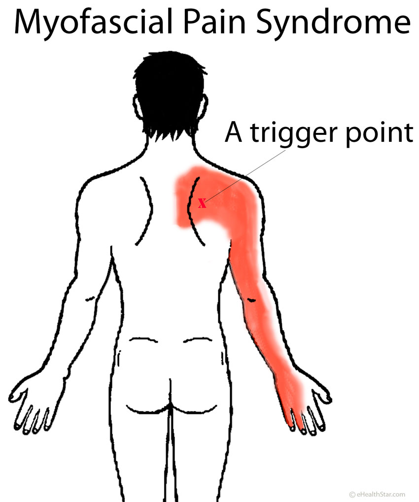 Acid Reflux Symptoms Pain Between Shoulder Blades