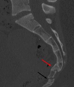 Coccyx Pain (Bruised Tailbone) Causes, Symptoms, Treatment - eHealthStar