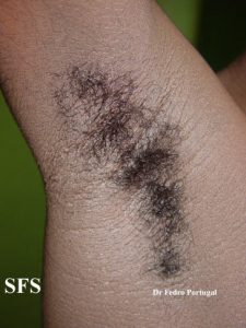 Armpit Rash (Red, Dark, Itchy, Painful Bumps): Causes, Pictures ...